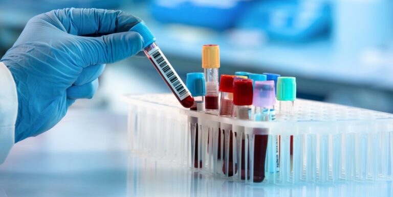 Sferocytoza wrodzona – jakie są objawy i przyczyny? | Diag.pl